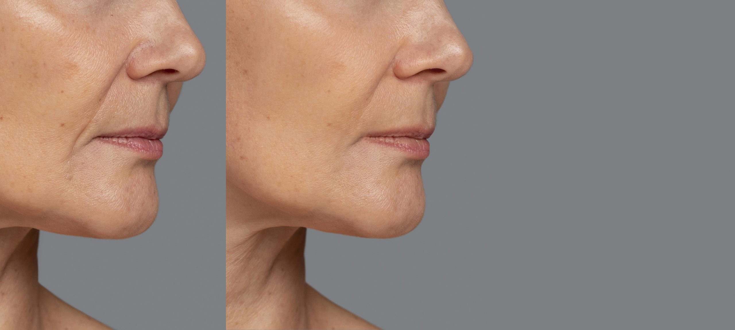 Nose to Mouth lines (Nasolabial Folds) - Aestiva Clinic