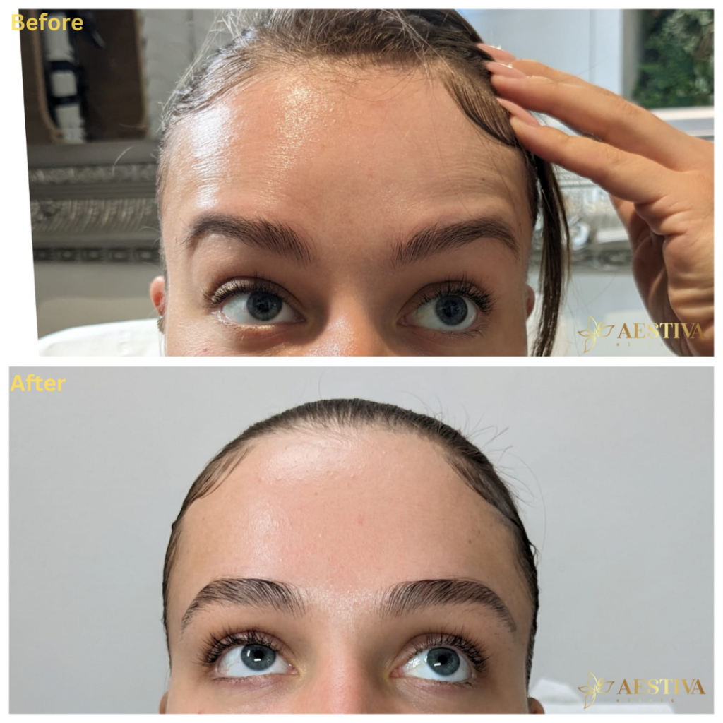 Forehead Lines Treatments - Aestiva Clinic