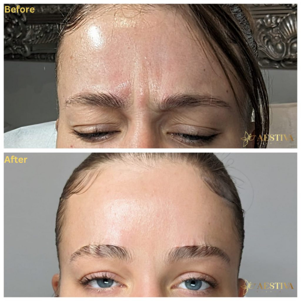 Frown Lines Treatments - Aestiva Clinic