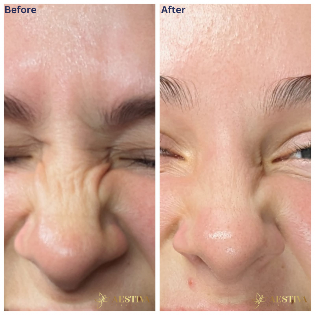 Bunny Lines Treatments - Aestiva Clinic