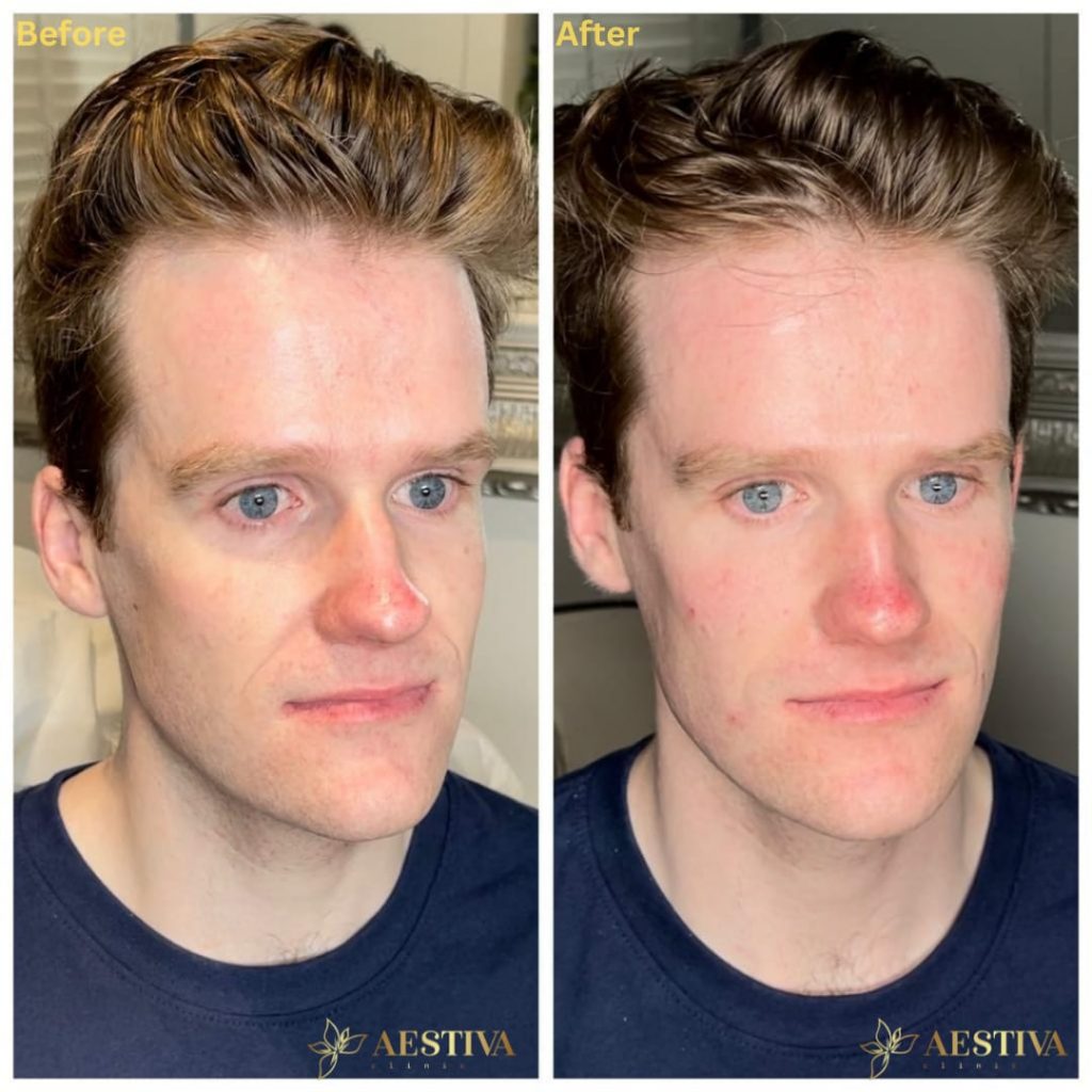 Tear-Trough Filler - Aestiva Clinic