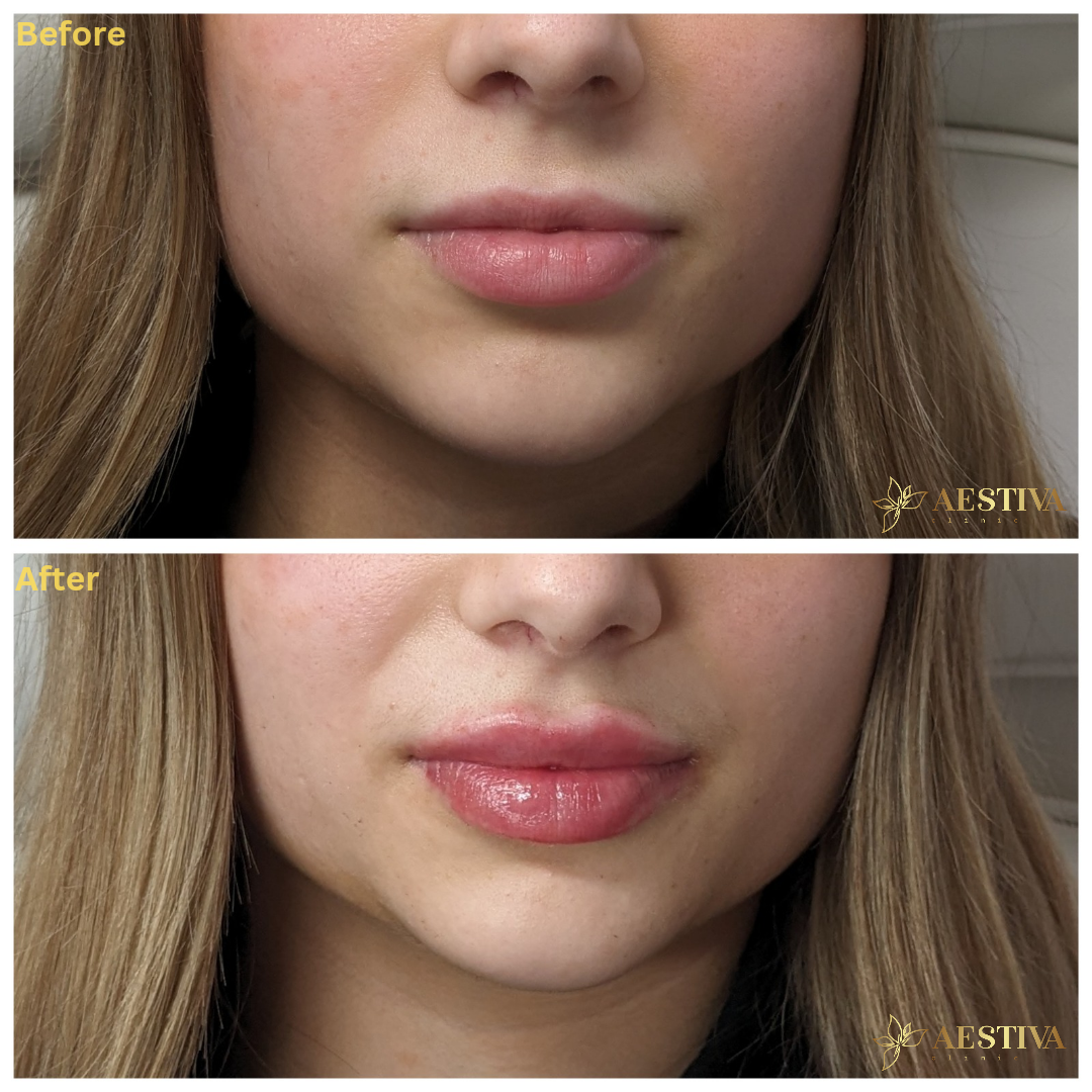 Aestiva Clinic - Medical Aesthetics in London and Kent